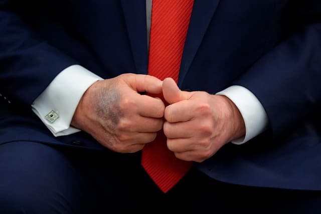Here's why Donald Trump has bruises on his hands