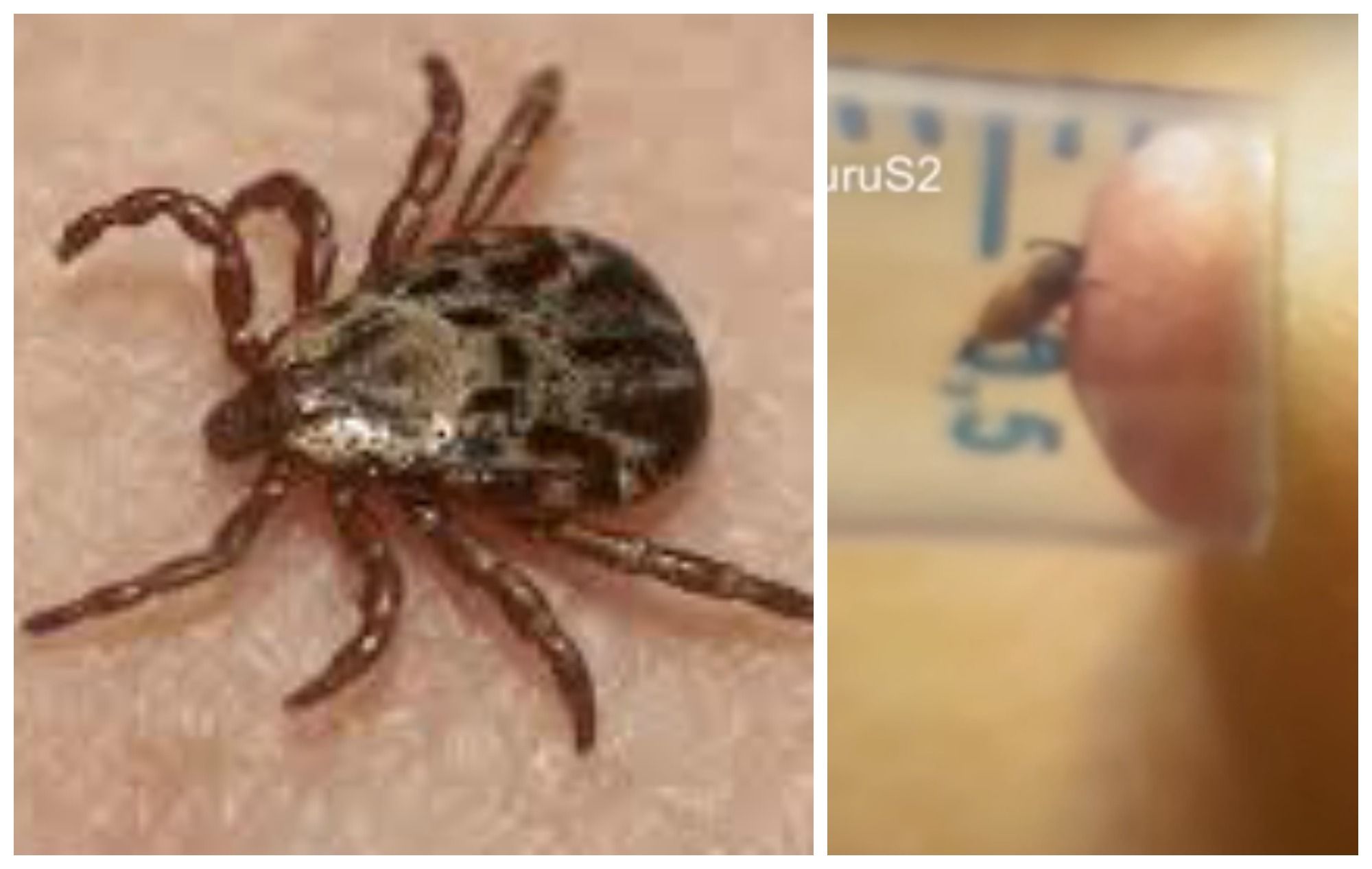 Watch how to stop a blood-sucking tick from burrowing into your leg ...
