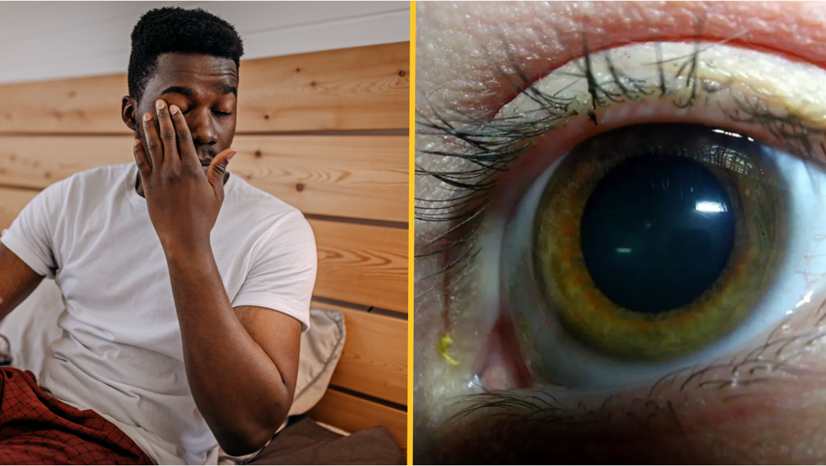 People baffled after discovering what yellow 'sleep' in eyes when you ...