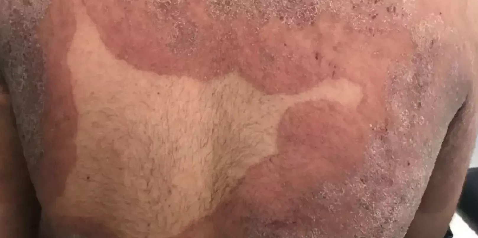 Drug-resistant fungus that attacks bum and groin is spreading rapidly ...